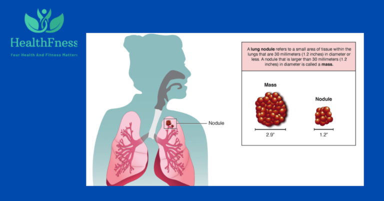 Ground Glass Nodule: The Hidden Danger in Your Lungs | HealthFness