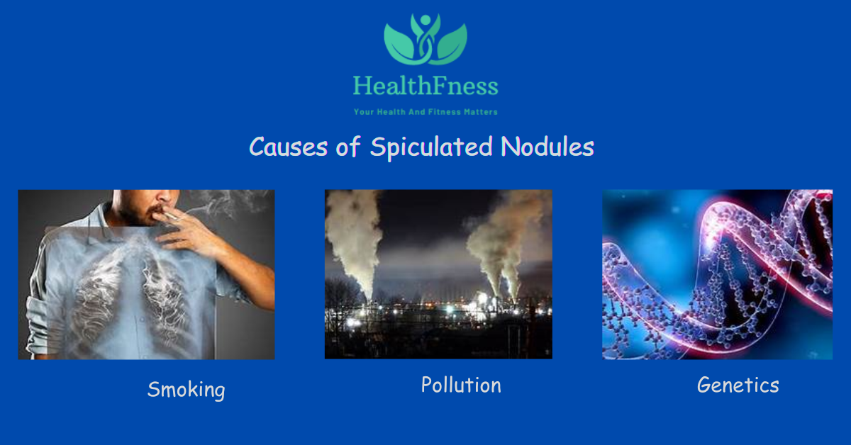Full Guide: Dangerous Spiculated Nodule 2024 | HealthFness