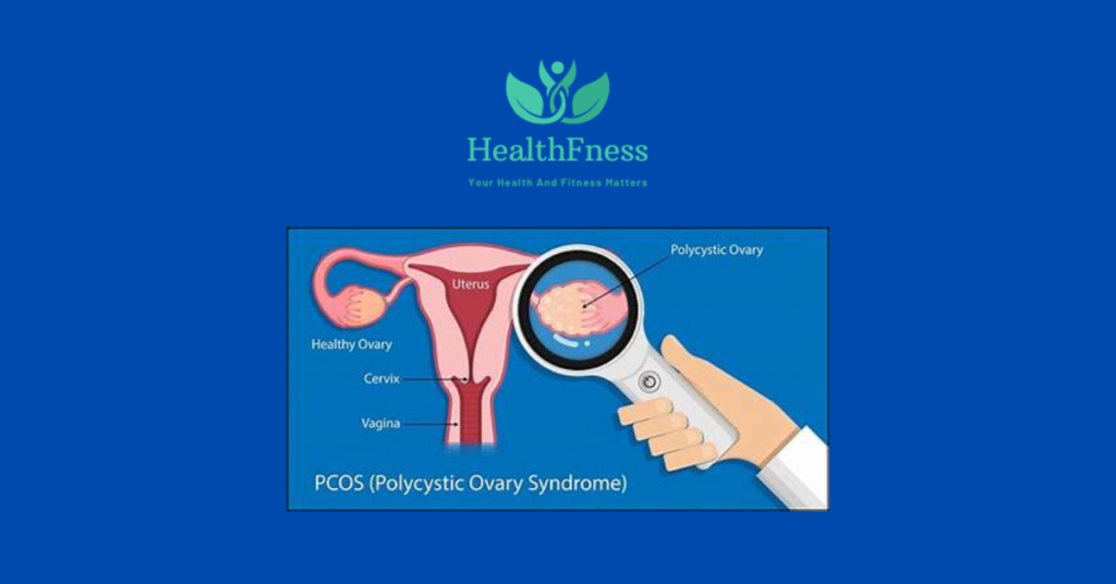 Unlocking the Connection Between Polycystic Ovaries and Bloating ...